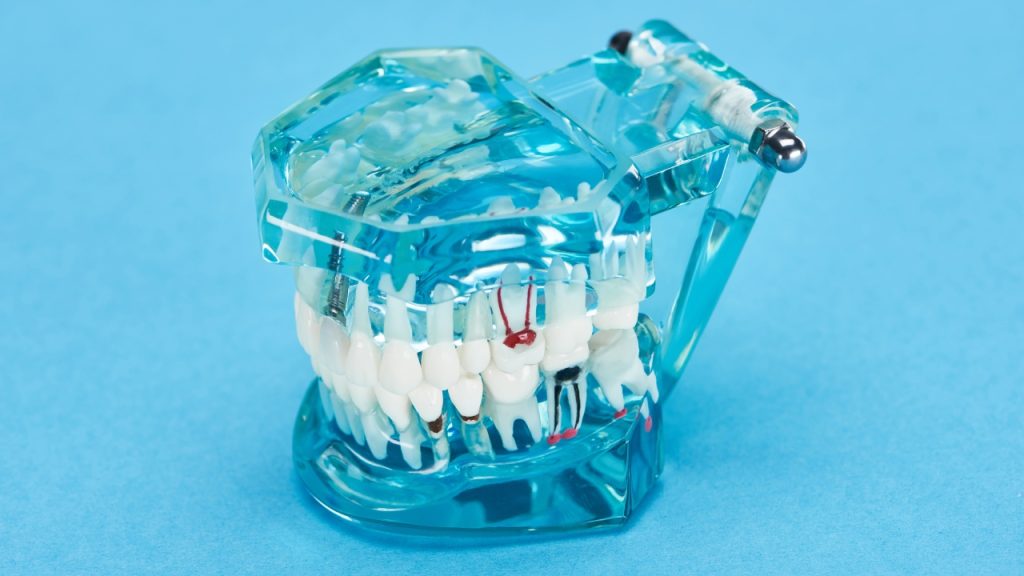 Your Guide To The Best TMJ Oral Appliance Options | Reimels Dentistry
